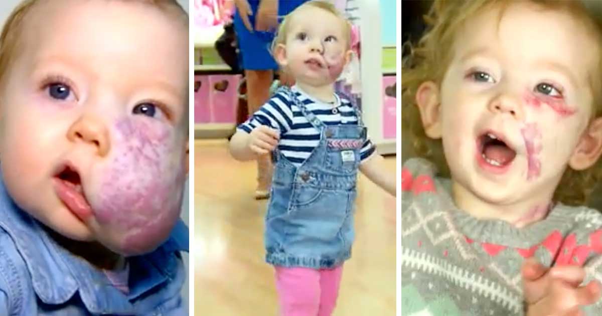 Adorable 2 Year Old s Facial Tumor Removed In Amazing Transformation